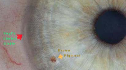 Modern & Multidimensional Iridology: Neurogenic, Vogt's Limbal Girdle ...