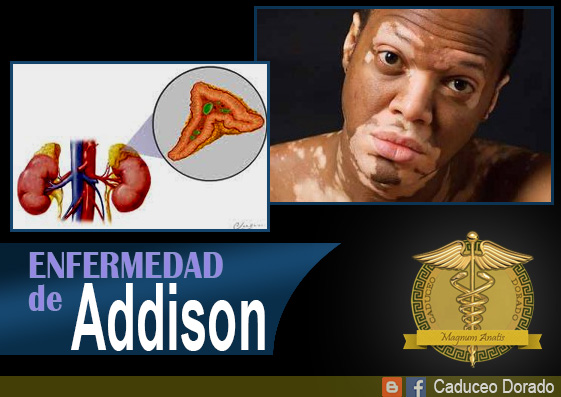 Caduceo Dorado: ENFERMEDAD DE ADDISON