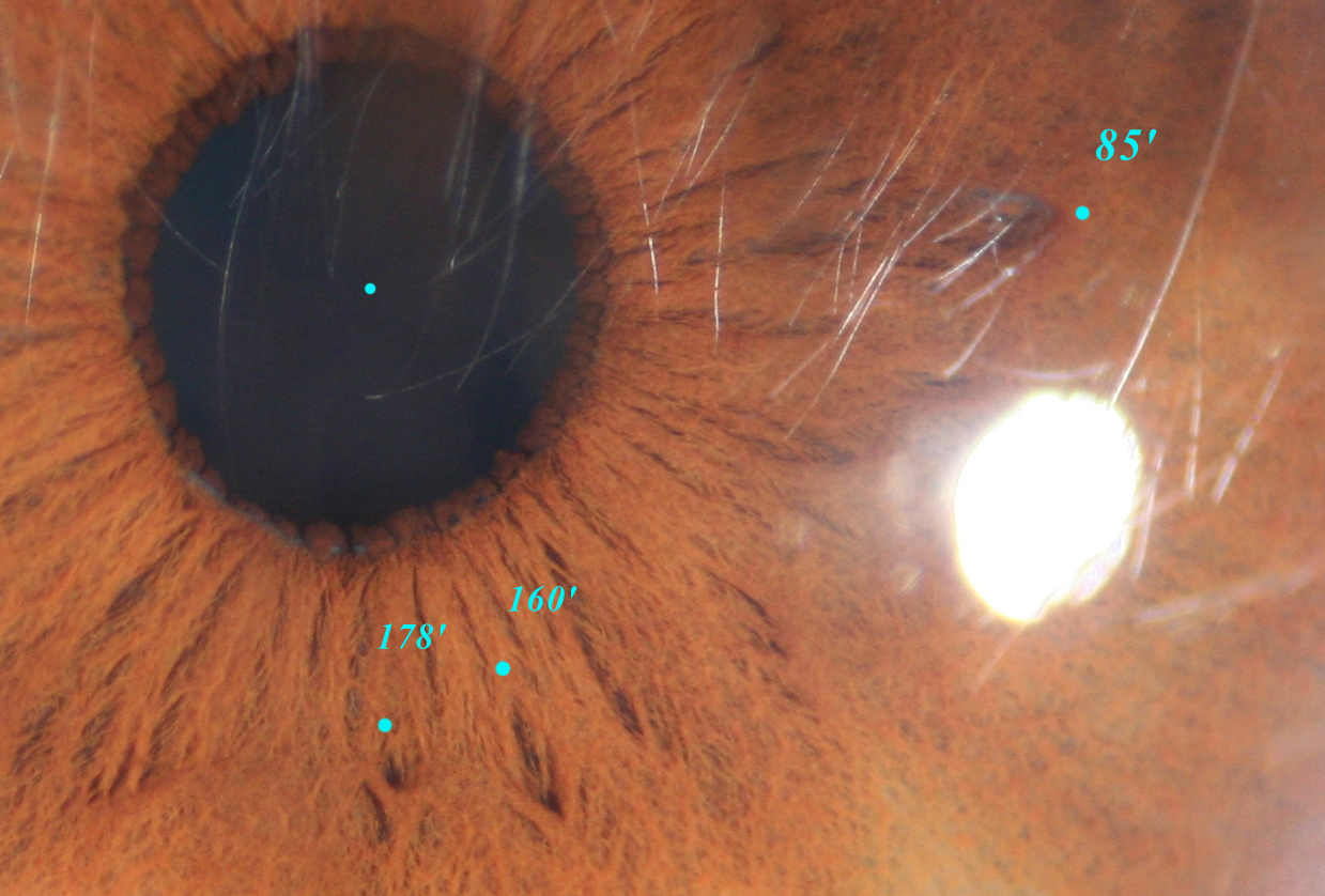 Modern & Multidimensional Iridology: Important iris Signs at IPB, Pupil ...