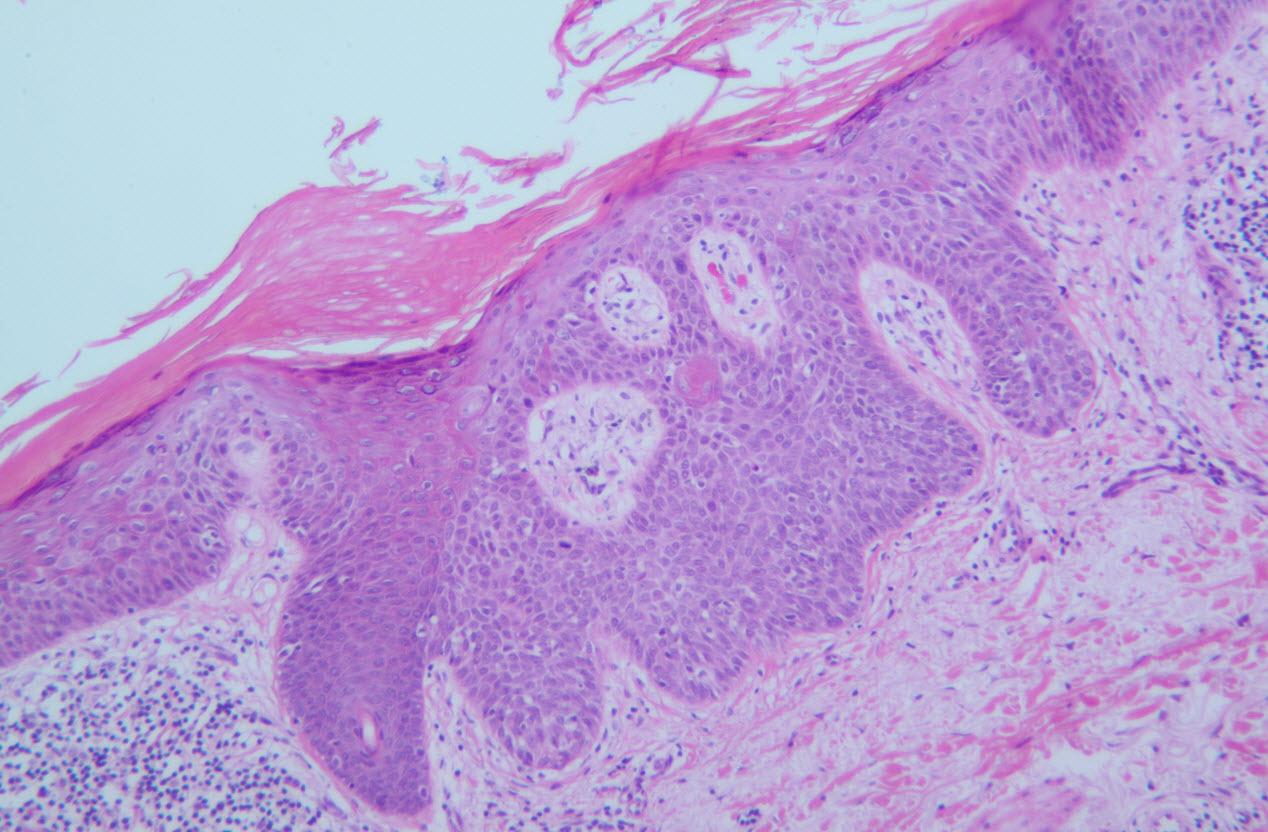 Consultations in Dermatoscopy: Blues revisited and a leg lesion