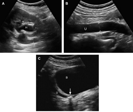 Renal Ultrasound Cases (Adrenal haemorrhage, Perinephric haematoma ...