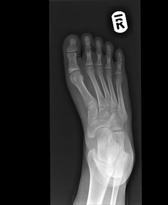 Daily Dose: cuboid fracture