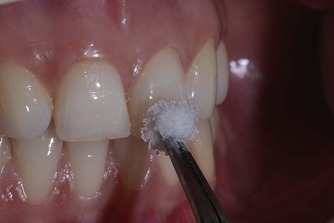 Diari Doktor Gigi: Gigi Mati (Pulp Necrosis)