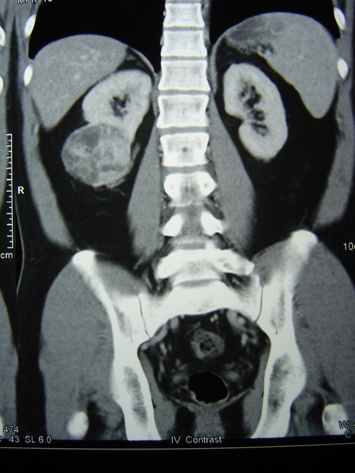 Bernard S Tjandra: Kencing Darah