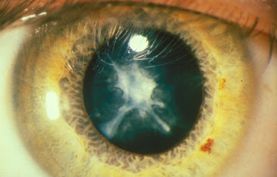 Deformutilation: Cataracts