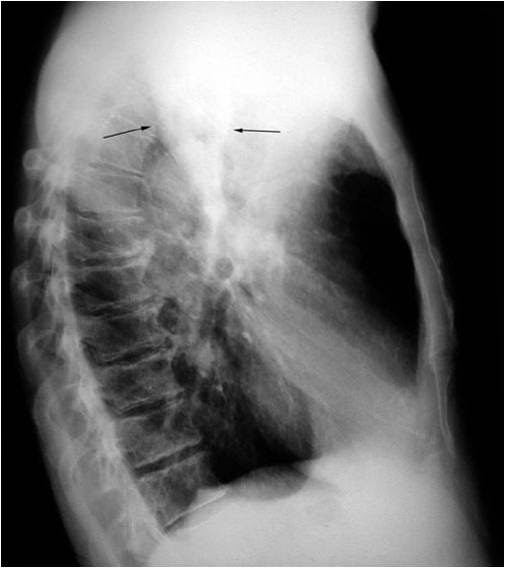 RADIOLOGY IMAGE SPOTTERS: Right upper lobe collapse