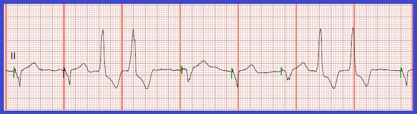 EKG Rhythm Strip Quiz 156