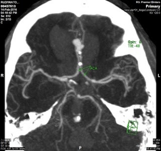 TEKNIK PEMERIKSAAN CT SCAN ANEURISMA ARTERI CEREBRALIS