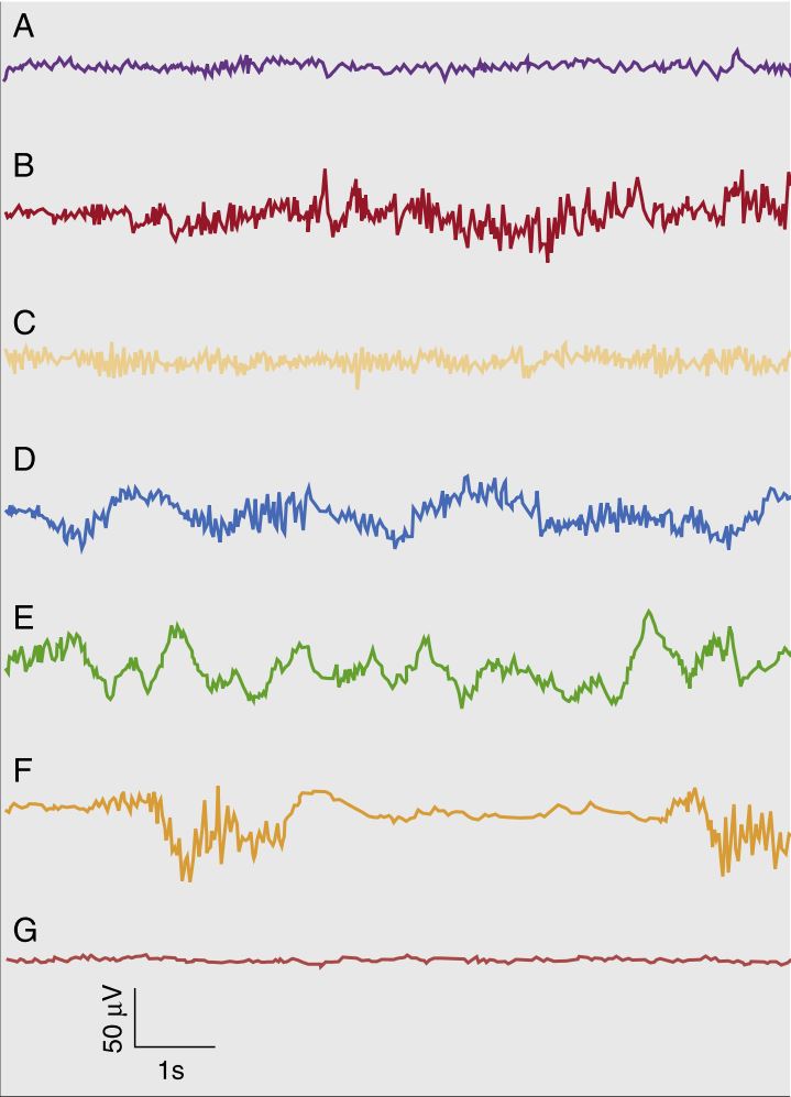 邱柏鈞醫師: BIS (Bispectral Index) 原理與鎮靜的應用