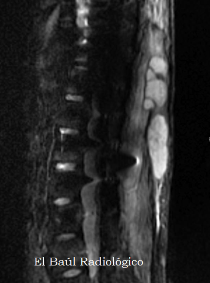 El Baúl Radiológico: SEROMAS POSTQUIRÚRGICOS PARAVERTEBRALES (Lumbar ...