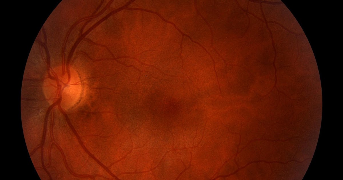 Sonoran Desert Eye Center Optic Nerve Hypoplasia