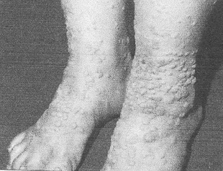PUBLIC HEALTH: VERRUCA A SKIN DISEASE