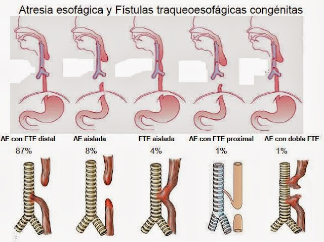 ATRESIA ESOFAGICA PDF
