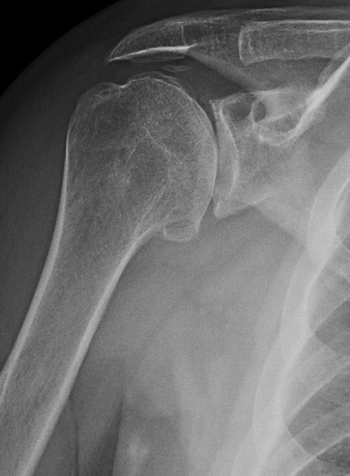 UW Shoulder and Elbow Academy: Shoulder joint replacement - humeral ...