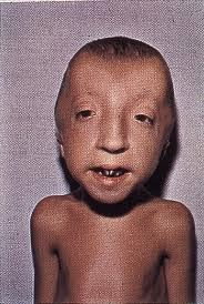 Medical Treatment Pictures-for Better Understanding: Seckel Syndrome