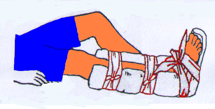 kUTEZEVO-pp: zlom gležnja