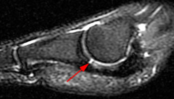 MRI Musculo-Skeletal Section: Turf toe.