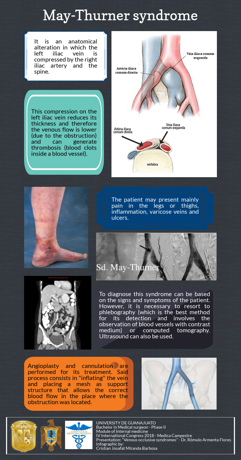 May-Thurner Syndrome - DIVULGACIÓN CIENTÍFICA UG