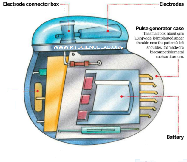 What is Pacemaker and How it Works