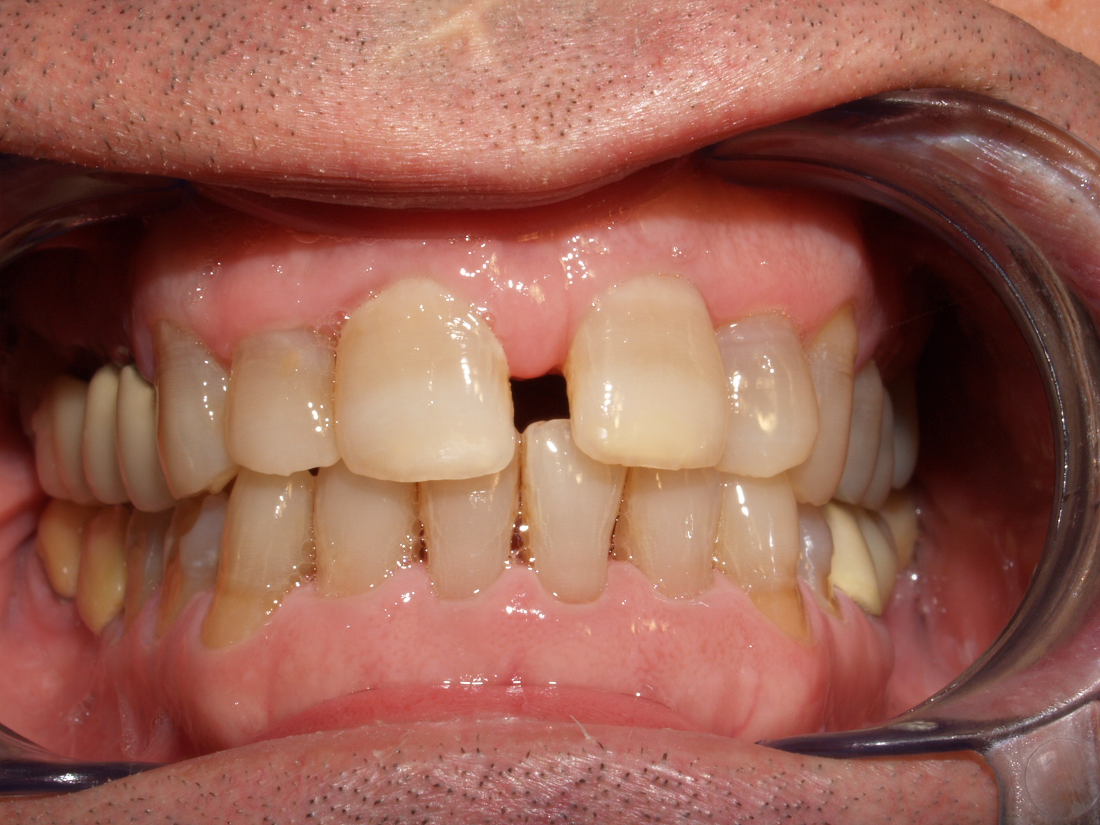 Clínica dental Dr. A. Castillo: PLACA BACTERIANA