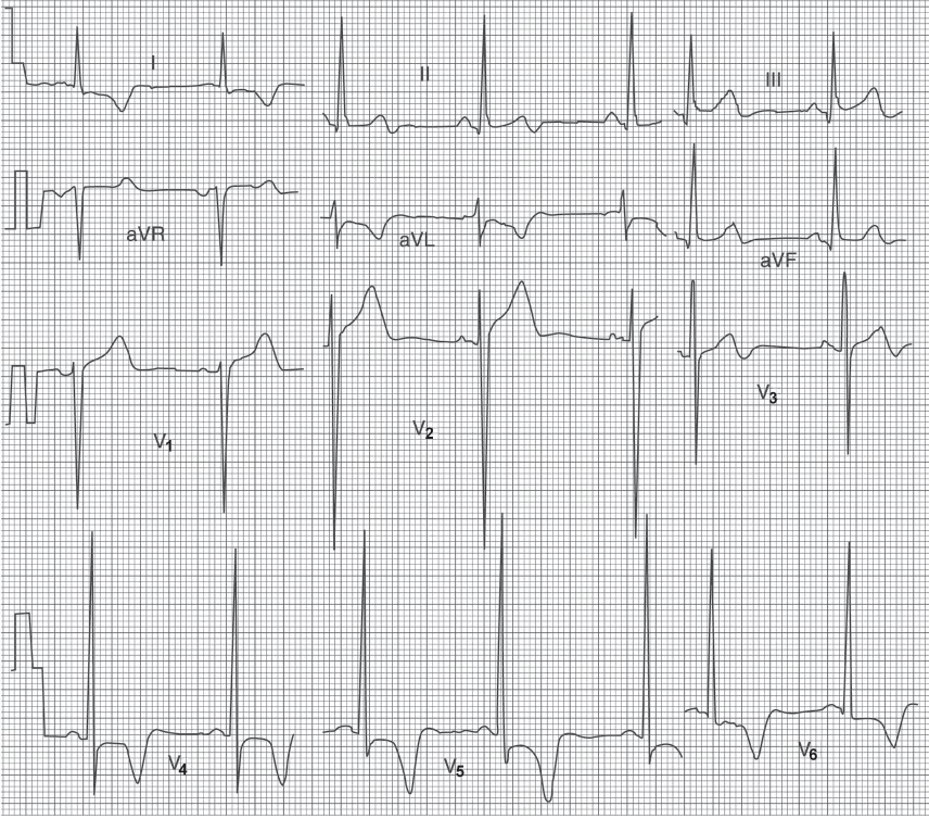 Ventricular Hypertrophy