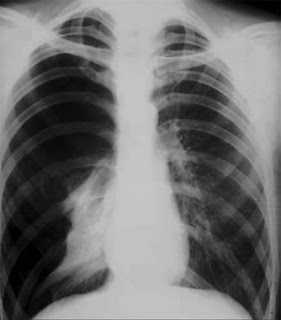 askep pneumothorax - Nursing & All About Health