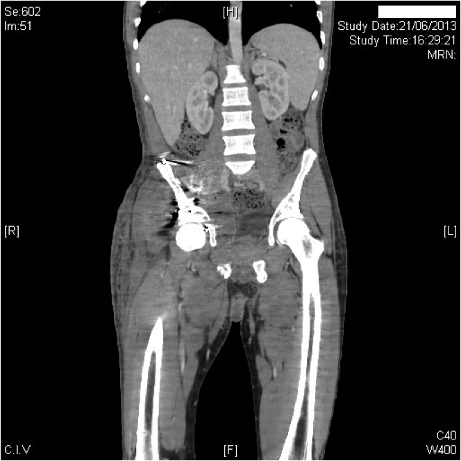 Caso 13: Piomiositis en paciente postoperado – Guía Terapéutica Antibiótica