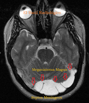 El Baúl Radiológico: ASPECTO DE LA CISTERNA MAGNA EN TOMOGRAFÍA ...