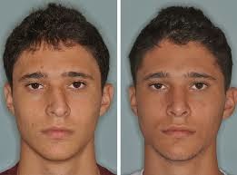 Medical Treatment Pictures-for Better Understanding: Septoplasty ...