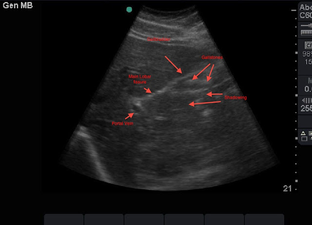 Porcelain Gallbladder ~ Ultrasound Cases Info