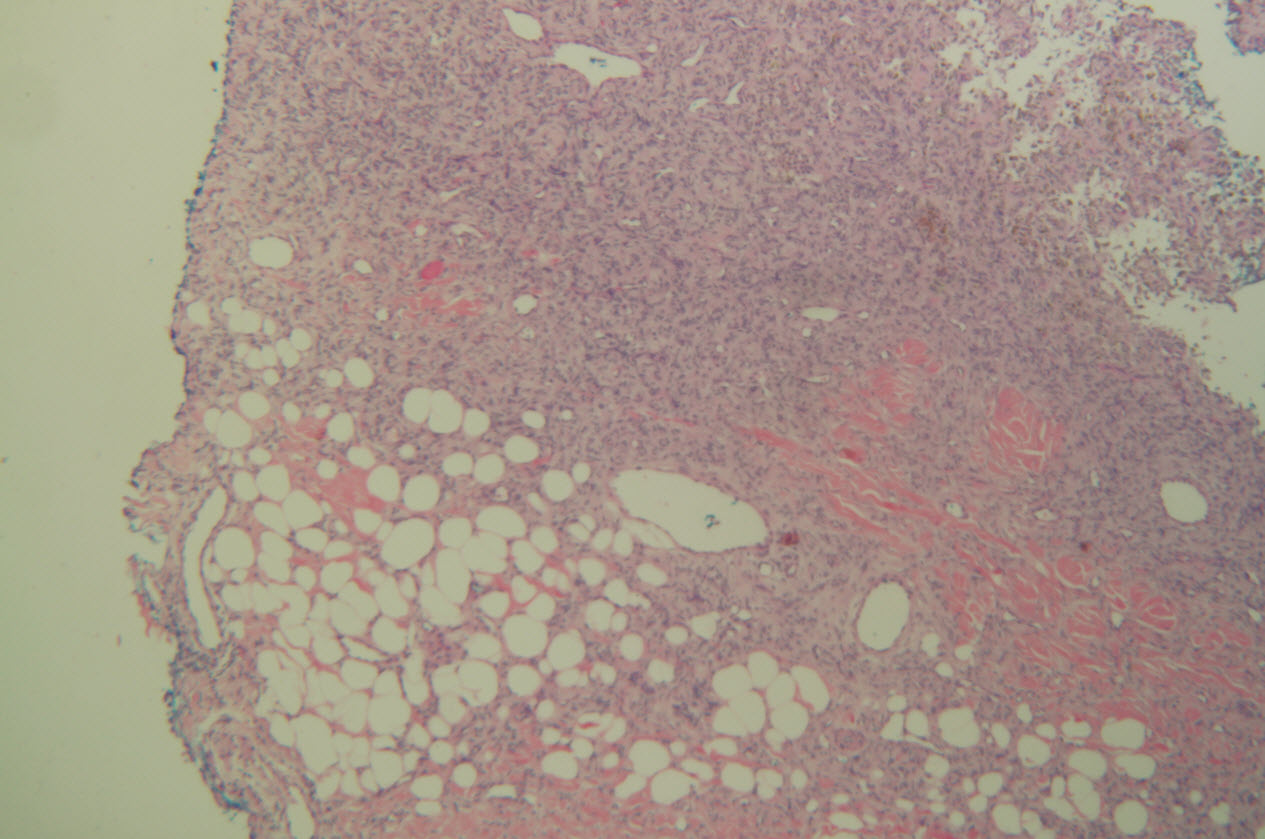 Dermpath Made Simple - Neoplastic: Dermatofibroma