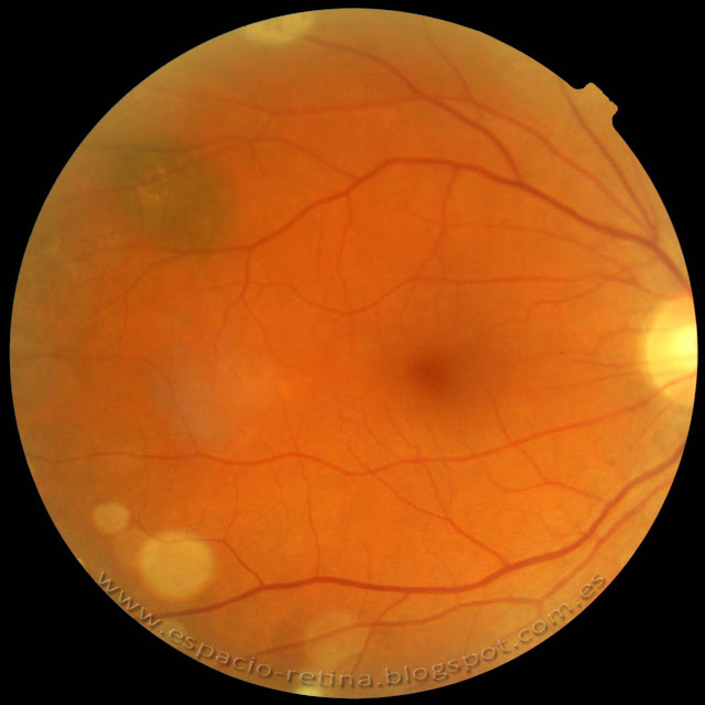 ESPACIO RETINA: Nevus + drusas.