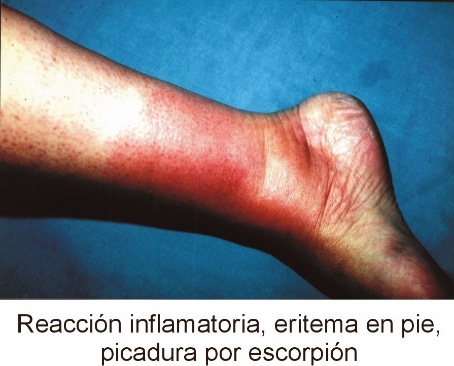 PICADURA Y MORDEDURAS DE ANIMALES: IMPORTANCIA DE LAS PICADURAS Y ...