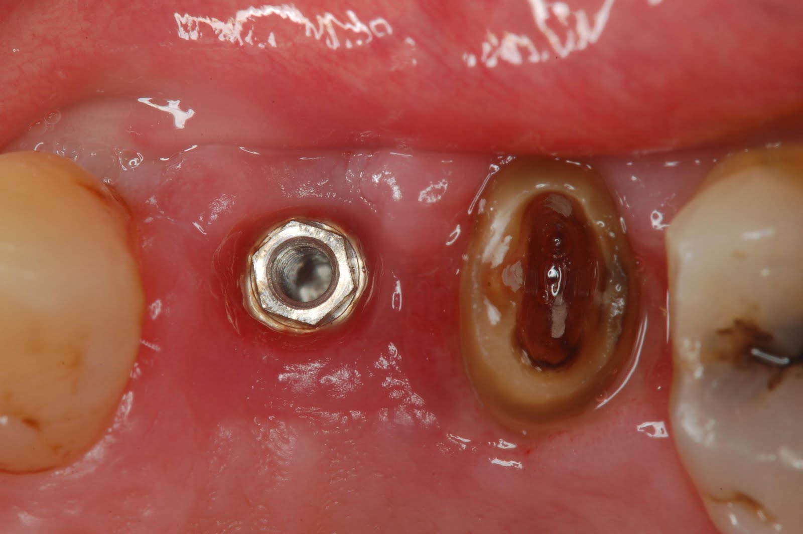 Docteur J.M. STROUMZA: PROFIL D’EMERGENCE : CLEF DE PERENITE IMPLANTAIRE
