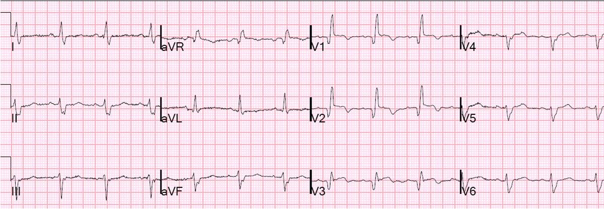 Dr. Smith's ECG Blog: What is the Diagnosis?
