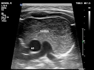 SONO DIGEST: ULTRASOUND CHEST- Empyema thoracis & Enlarged Thymus