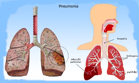 Consultoria de Enfermagem Mendes & Hernandez: Enfisema Pulmonar e ...