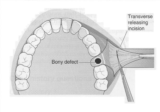 WizDent: Buccal advancement flap