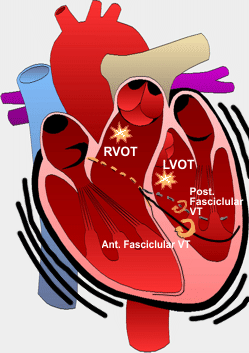 Fascicular Ventricular Tachycardia | INA - ECG