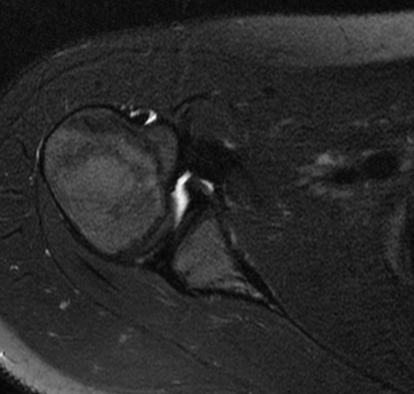 Shoulder and Elbow Surgery: Posterior chondrolabral cleft and recurrent ...