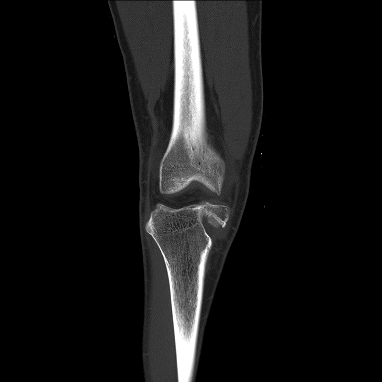 CT Knee - Radiology Imaging