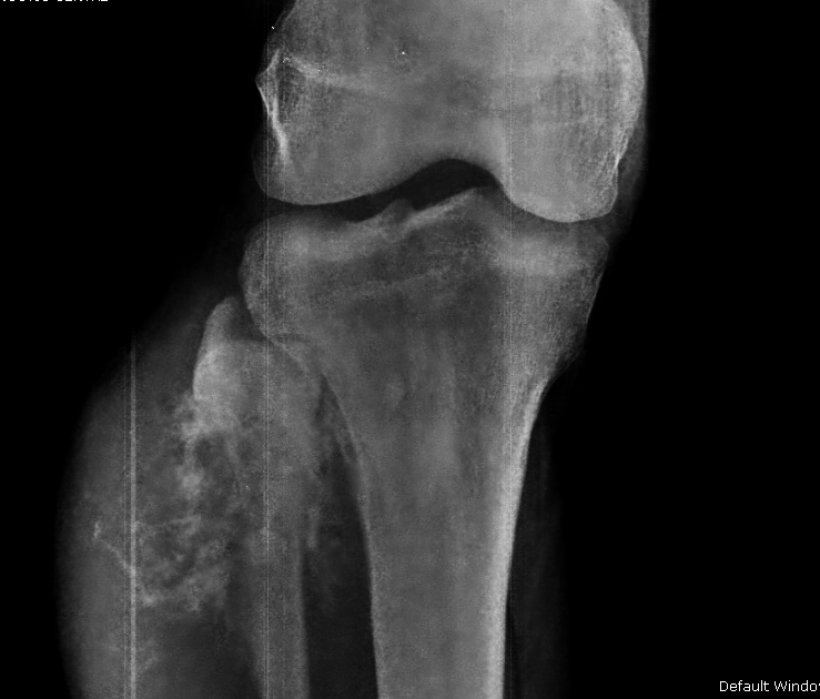 Fibular osteosarcoma-Imaging - Sumer's Radiology Blog