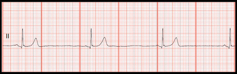 ACLS review: Bradycardia part 1