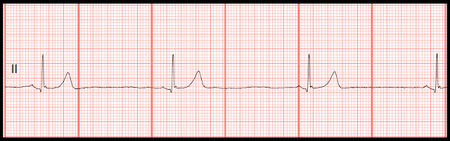 ACLS review: Bradycardia part 1
