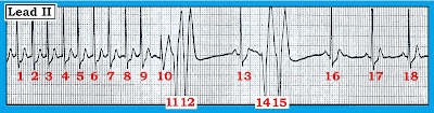ECG Interpretation: ECG Blog #136 (AVNRT – Vagal Maneuver – PVC ...