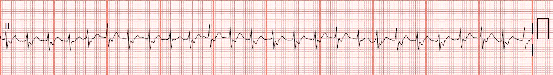 Basic ECG Rhythms