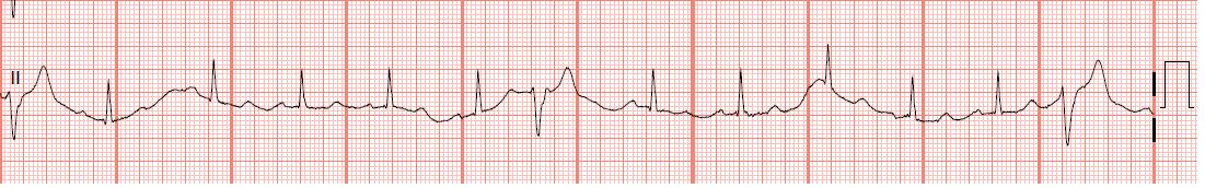 Float Nurse: EKG Rhythm Strips 26: Ectopic beats