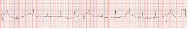 EKG Rhythm Strips 26: Ectopic beats