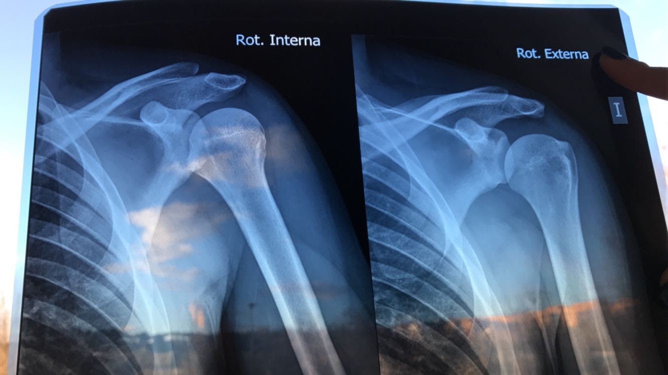 Subluxación acromioclavicular