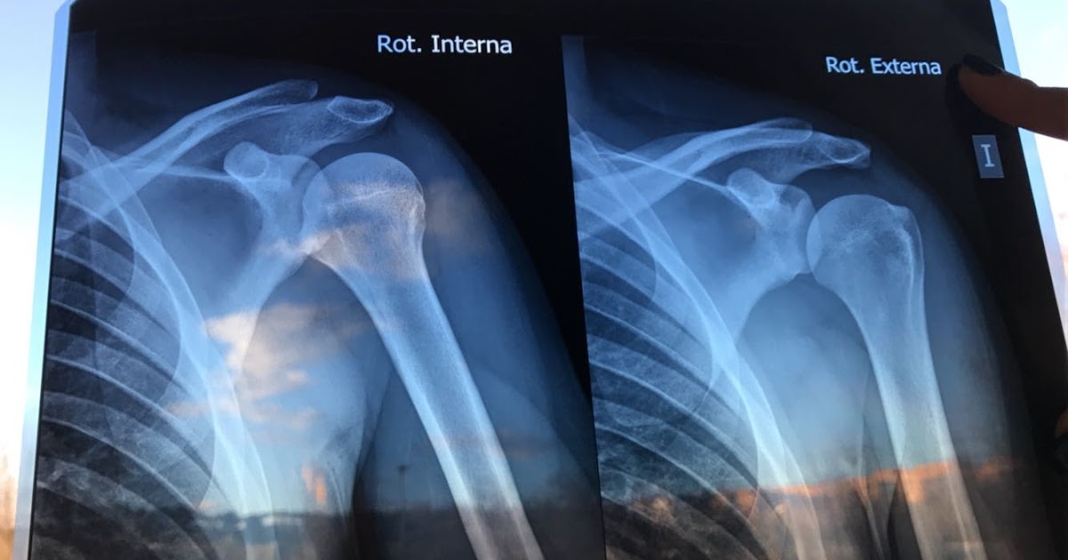 Subluxación acromioclavicular